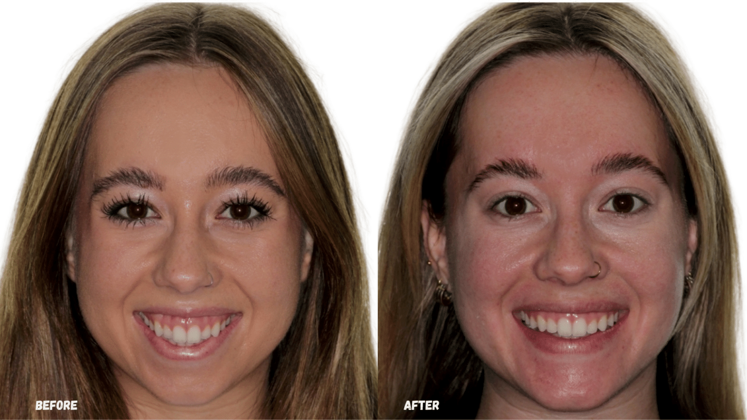 Gummy Smile Correction at Digiovanni Orthodontics