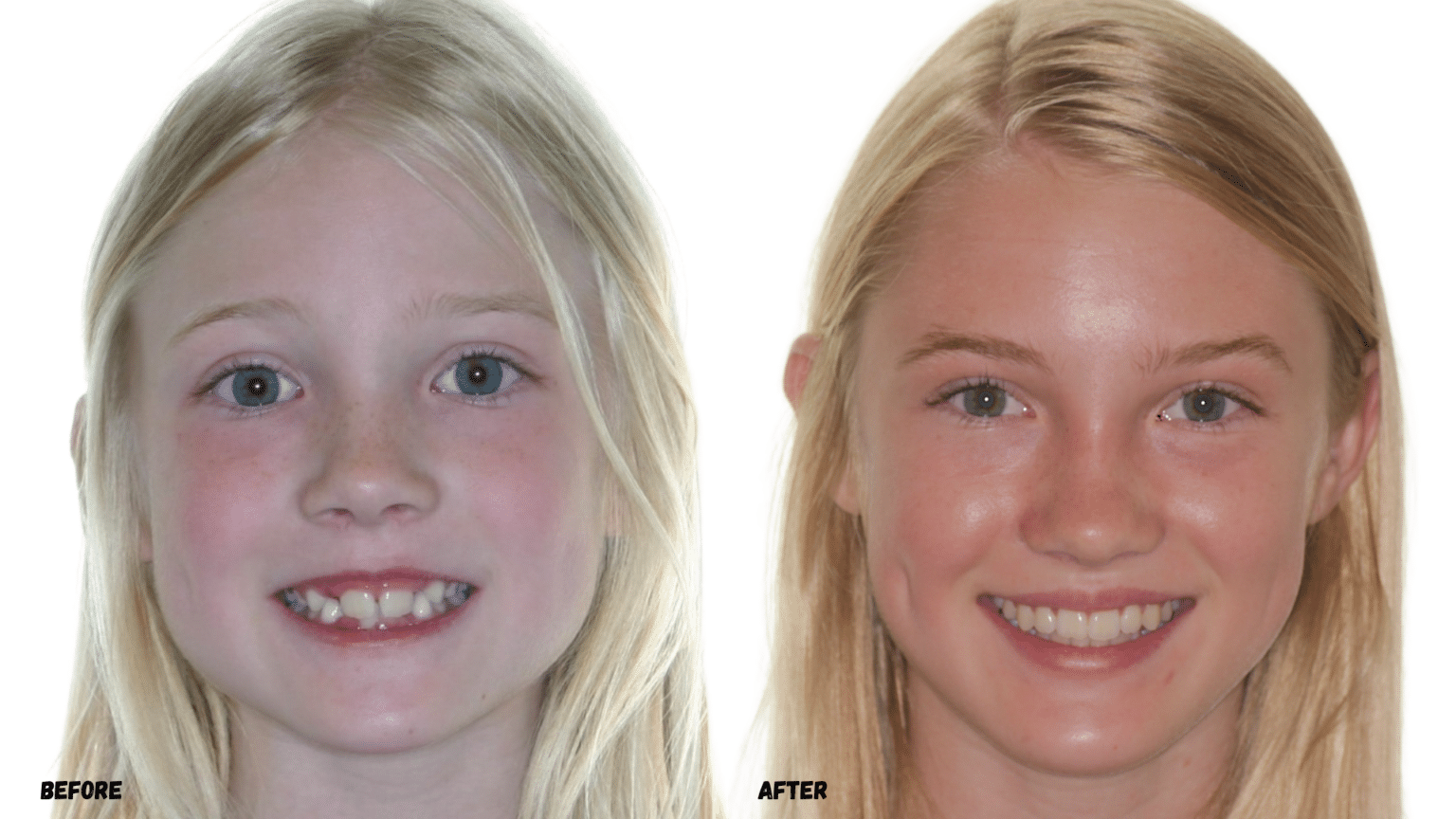 Gummy Smile Correction at Digiovanni Orthodontics