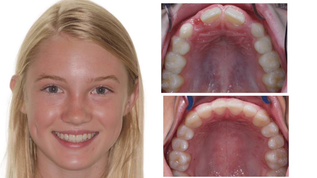Arch Expansion Newport Beach Laguna Beach | Digiovanni Orthodontics