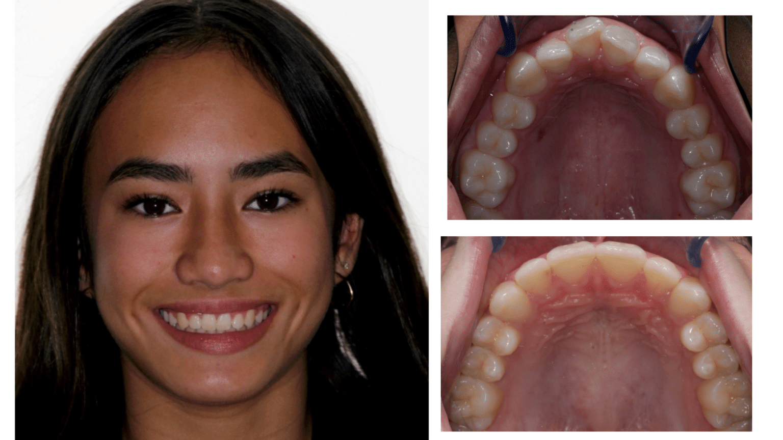 Arch Expansion Newport Beach Laguna Beach | Digiovanni Orthodontics