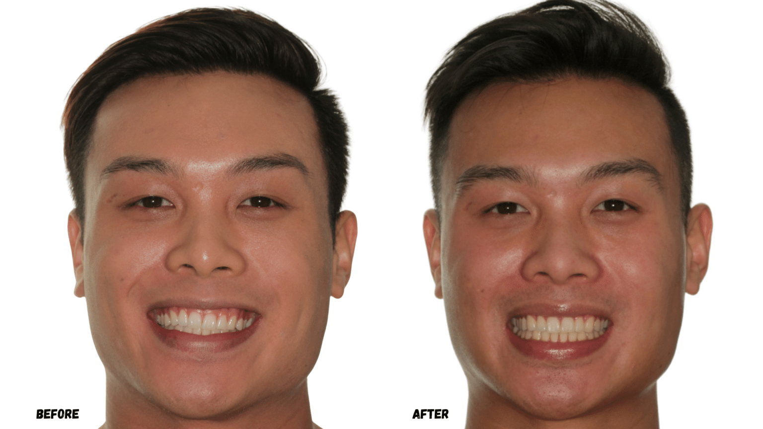 Gummy Smile Correction at Digiovanni Orthodontics