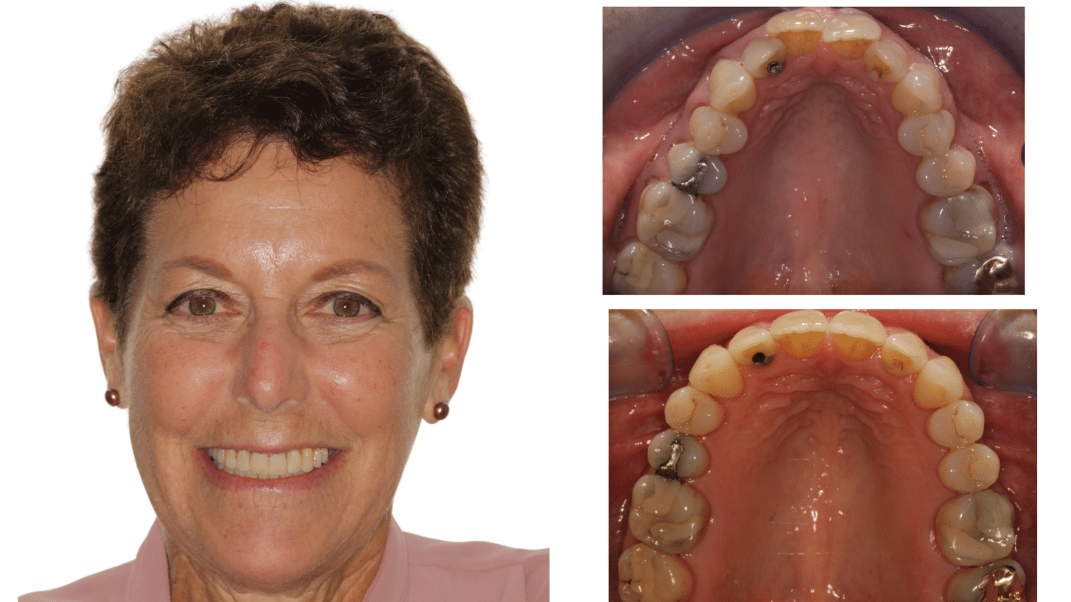 Arch Expansion Newport Beach Laguna Beach | Digiovanni Orthodontics