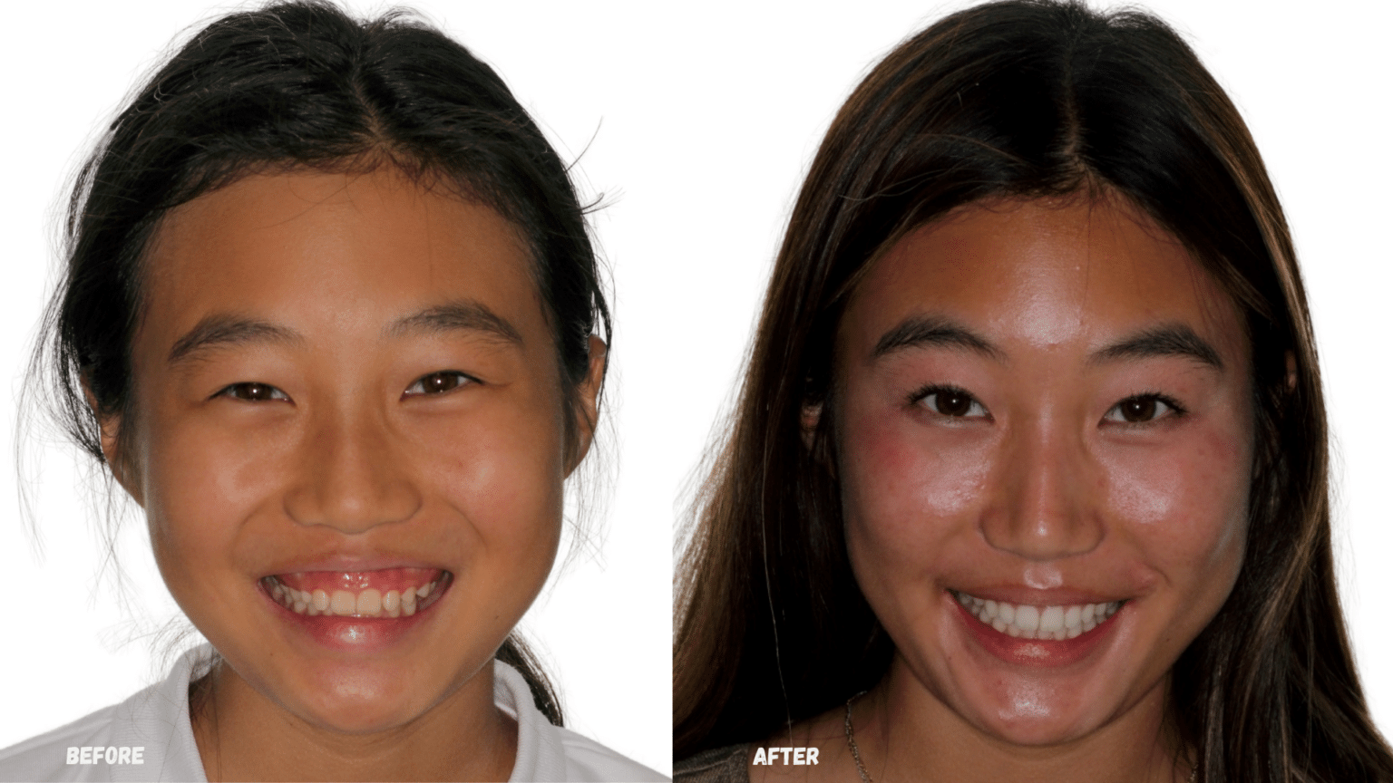 Gummy Smile Correction at Digiovanni Orthodontics