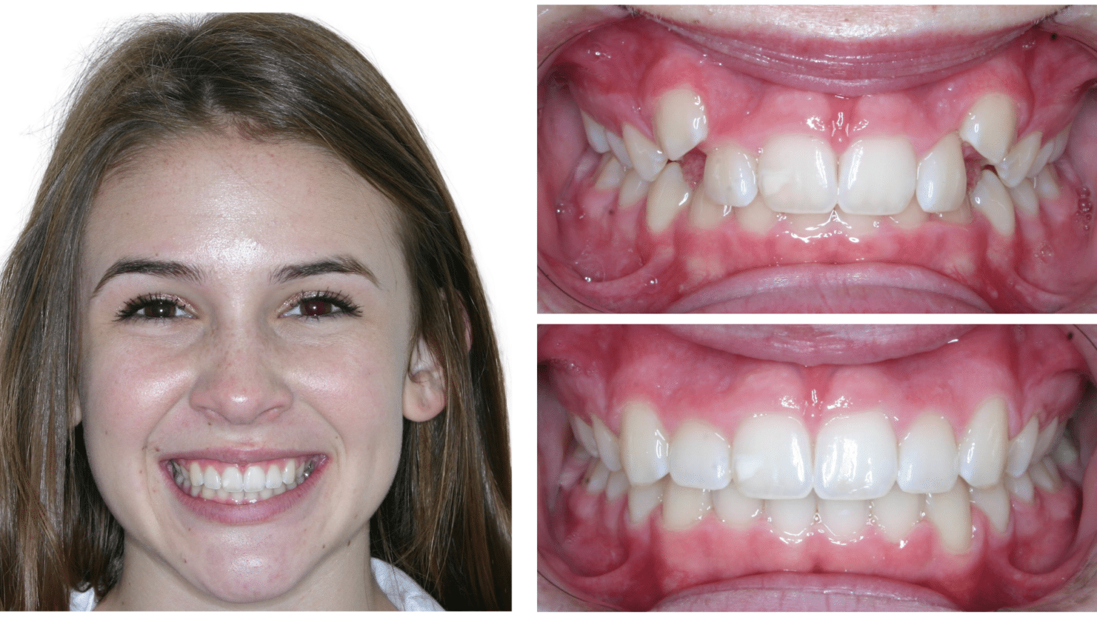 Severe Crowding Newport Beach Laguna Beach CA